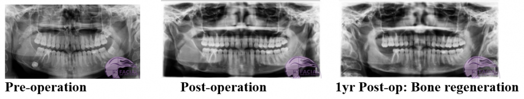 Surgical treatment of cystic lesions in the jaw – Facial and Oral ...