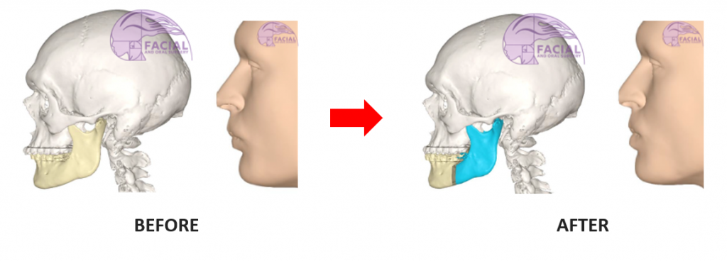 Orthognathic Surgery – Facial and Oral Surgery – Christine Lwin